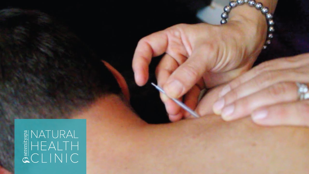 Acupuncture - YouTube