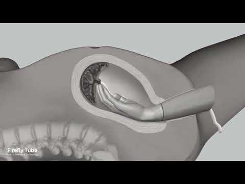 Vaginal Delivery: How to perform manual removal of the placenta (3D Animation)
