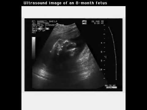 Ultrasound of 8 months Fetus Animation - YouTube