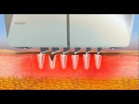 Invasix Fractora - YouTube