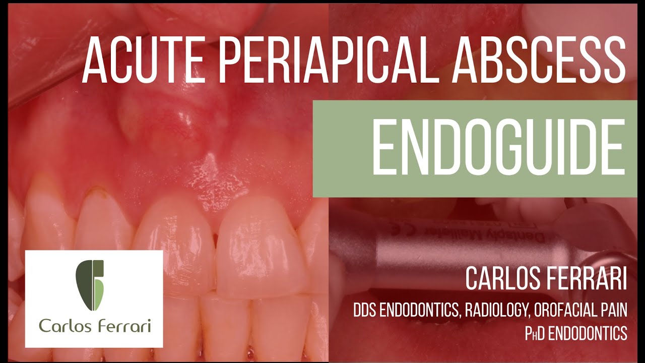 Acute Periapical Abscess and Endoguide - YouTube