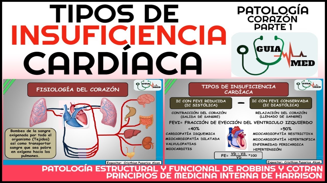 INSUFICIENCIA CARDÍACA DERECHA E IZQUIERDA FISIOPATOLOGÍA | GuiaMed ...
