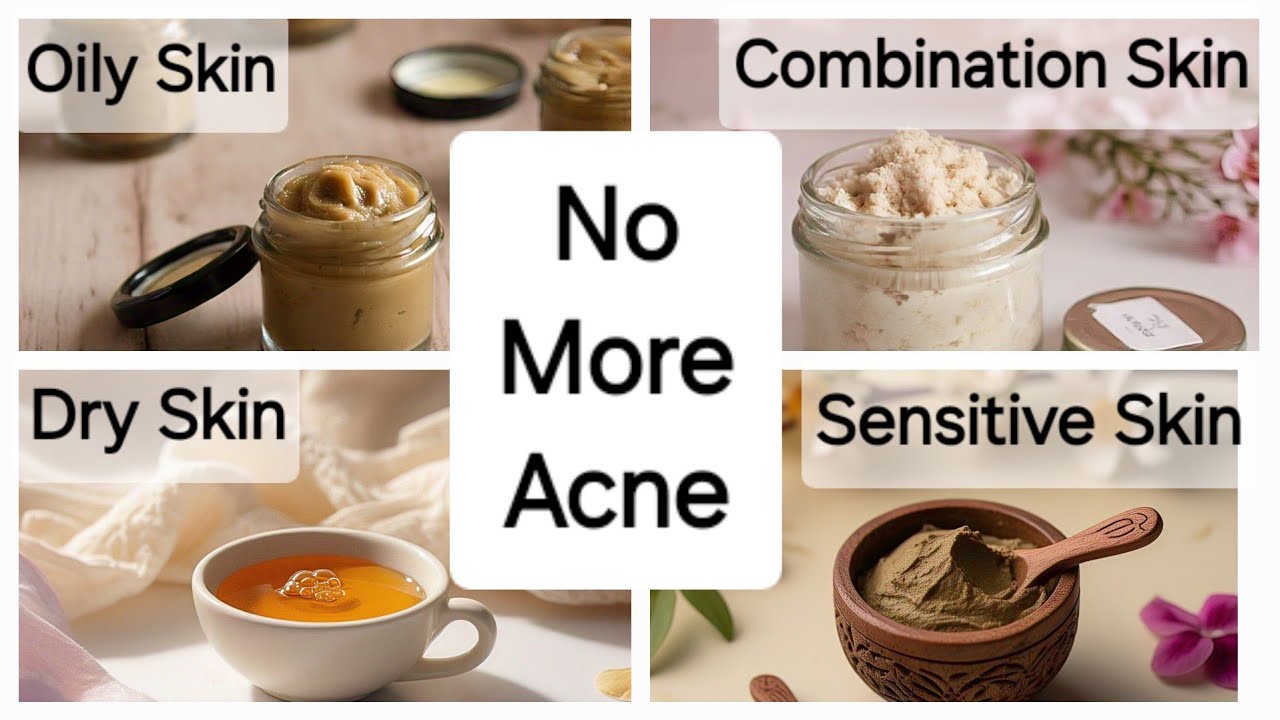 Acne treatment at home/ face pack for glowing skin homemade - YouTube