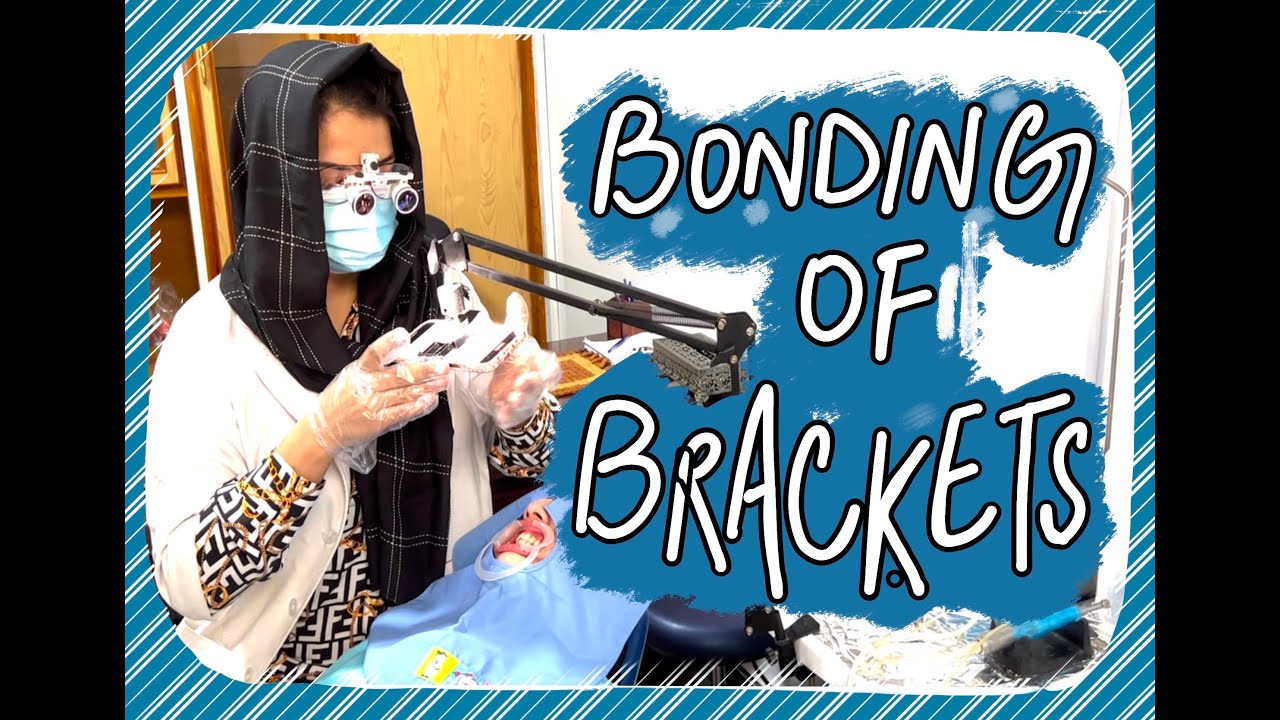 Bonding of Orthodontic Brackets - YouTube