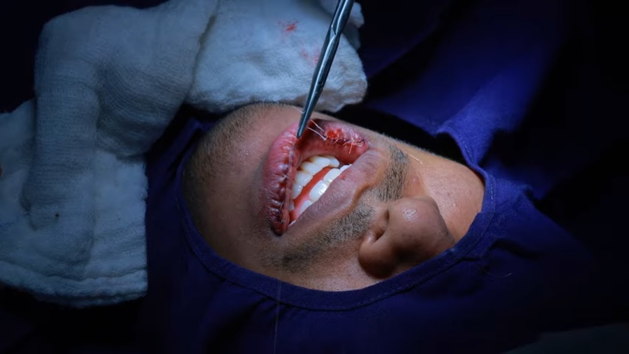 Lip Reduction Cosmetic Surgery | Before and After Results - YouTube