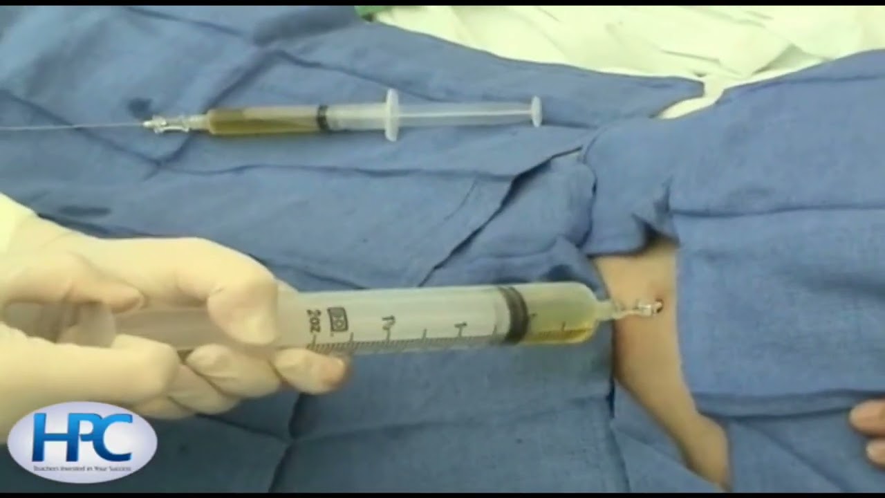 La paracentèse (ponction d'ascite) - YouTube