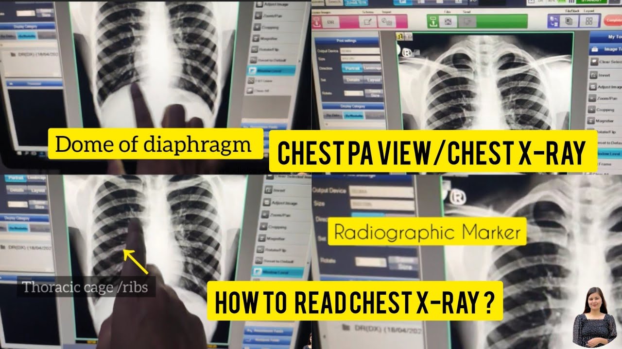 Chest PA view || RadiologyStudy7 || #education #radiology #xray # ...