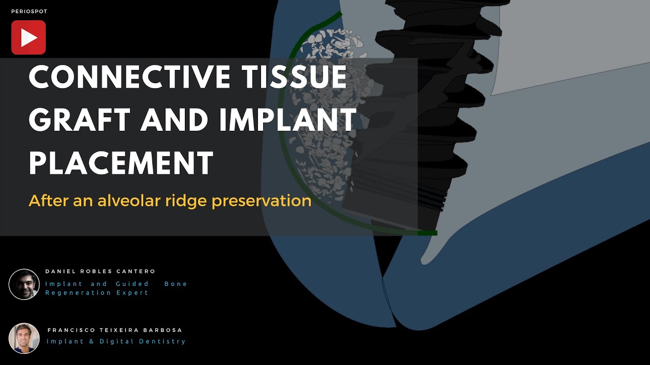 Implant Placement with Connective Tissue Graft - YouTube