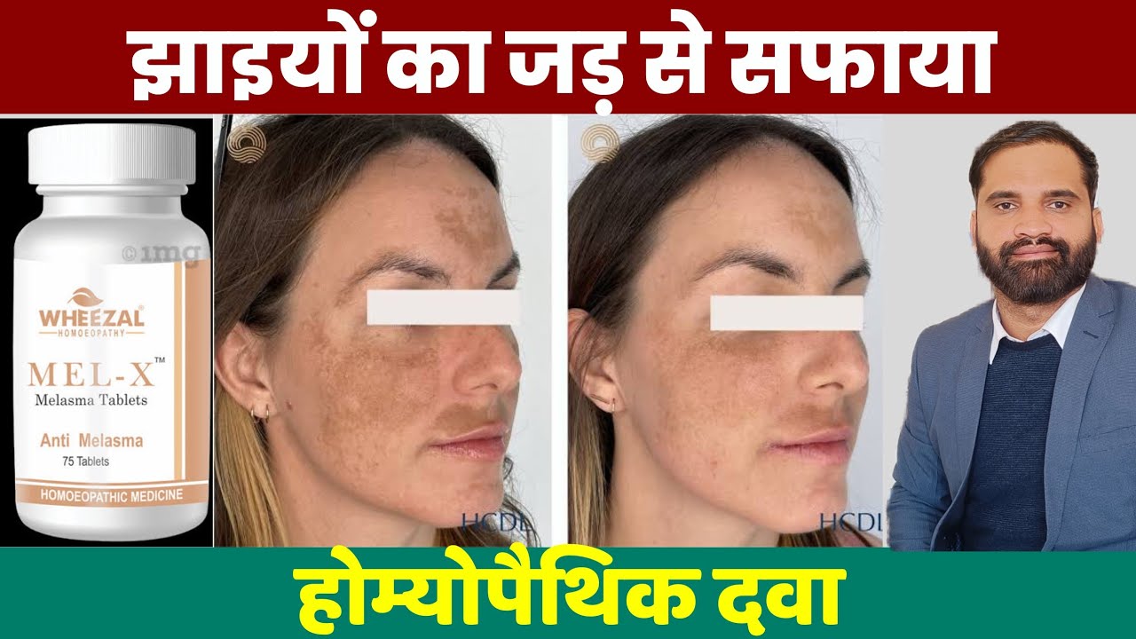 Mel x melasma tablet review | Mel x melasma tablet uses in hindi - YouTube