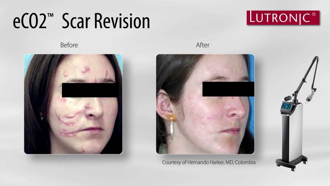 Lutronic AAD 2012 .mp4 - YouTube