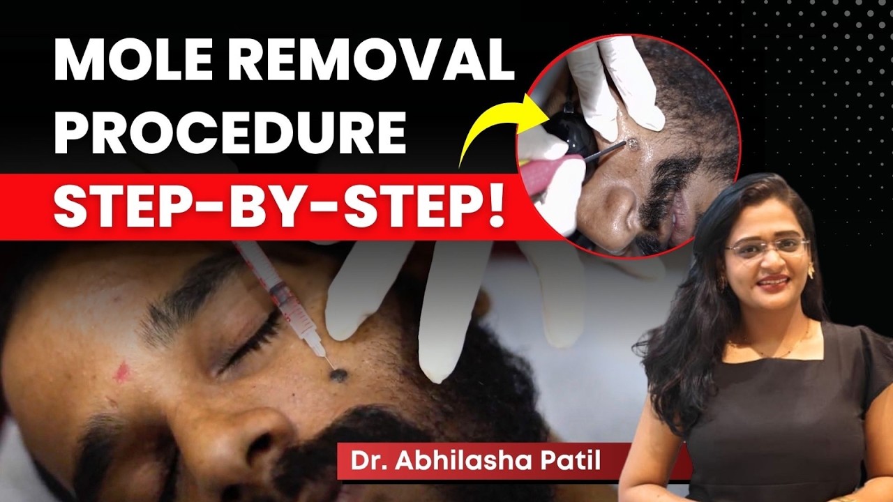 Live Mole Removal Procedure Using Radiofrequency | Watch the Full ...