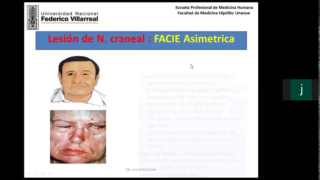 Facies, actitud y marcha - semiologia neurológica - YouTube
