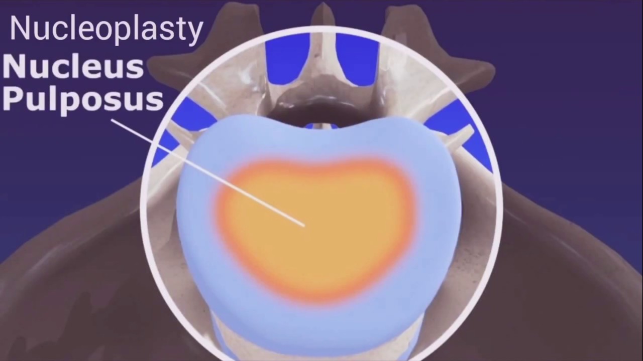 Disc Nucleoplasty - YouTube