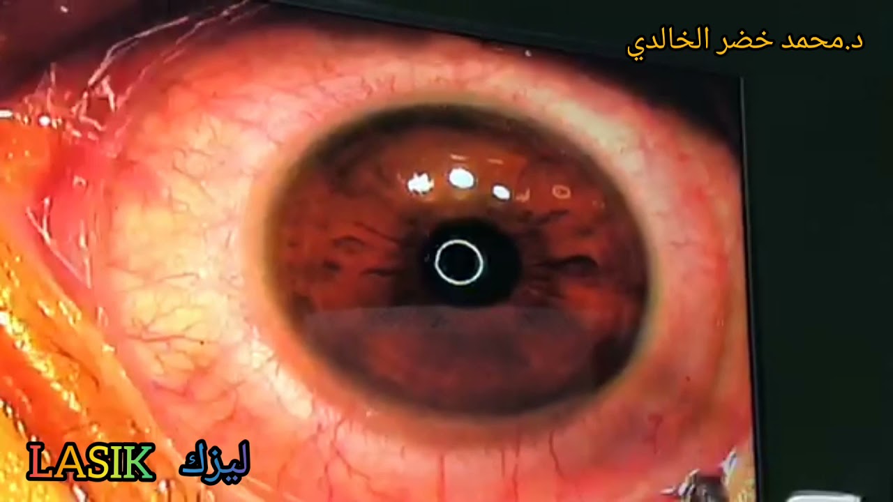 LASIK eye Surgery...Using Visx - YouTube
