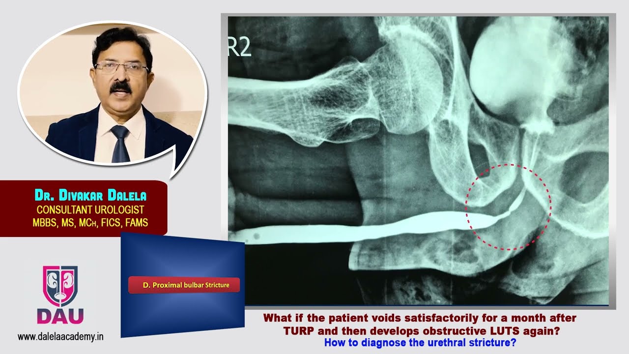 Post TURP Recurrent LUTS Diagnosis making - YouTube