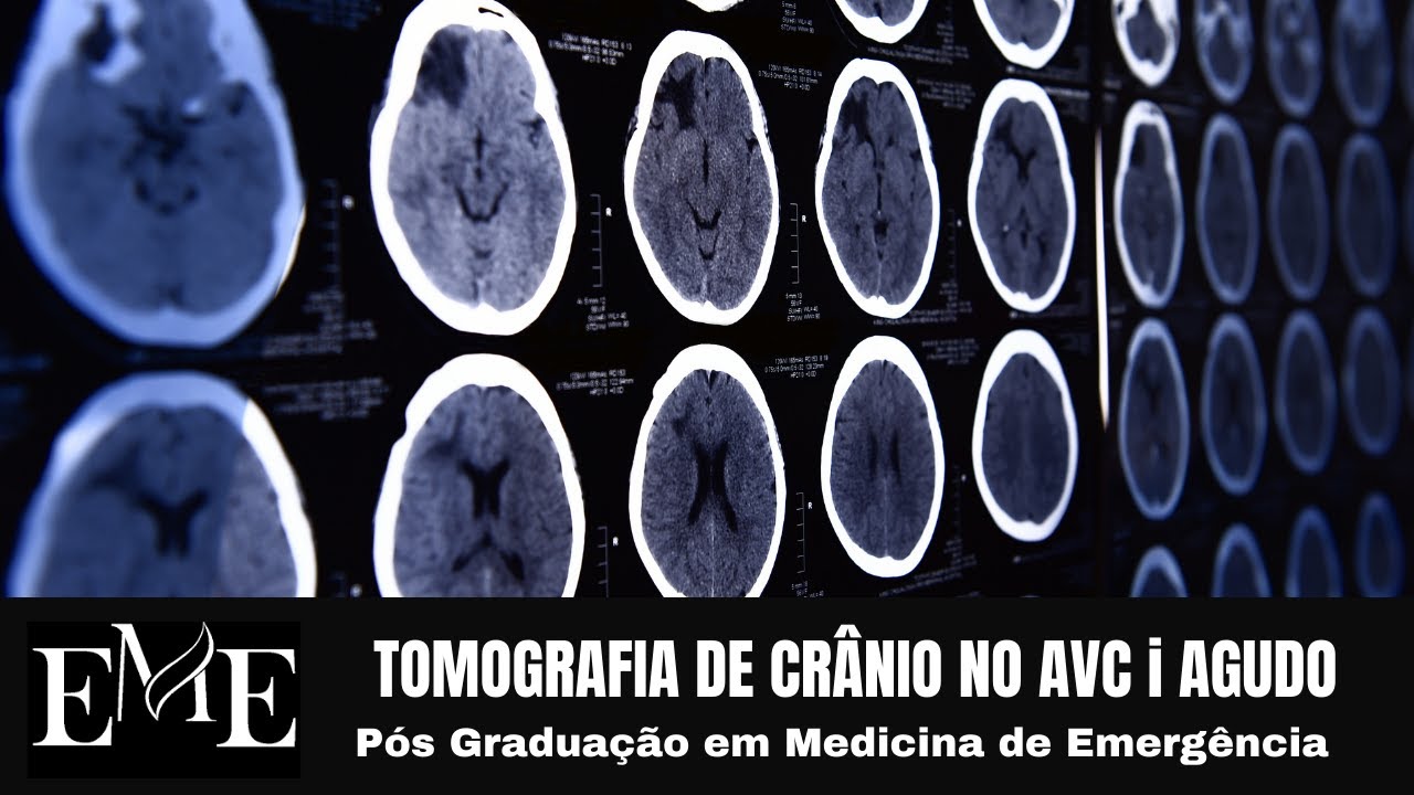 Você sabe como identificar um AVC isquêmico na CT crânio de entrada ...