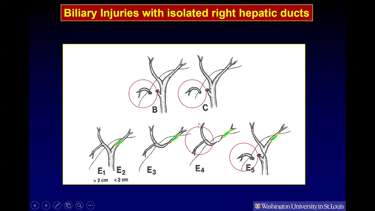 Preoperative and Operative Strategies in the Management of Biliary ...