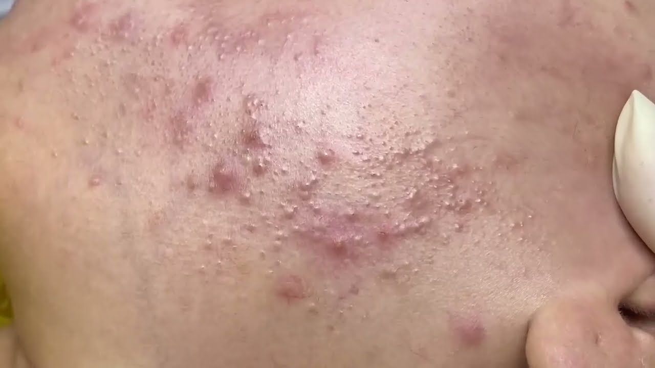 Relax Every Day With Wellness Spa 121 Acne Treatment Best Sac Dep