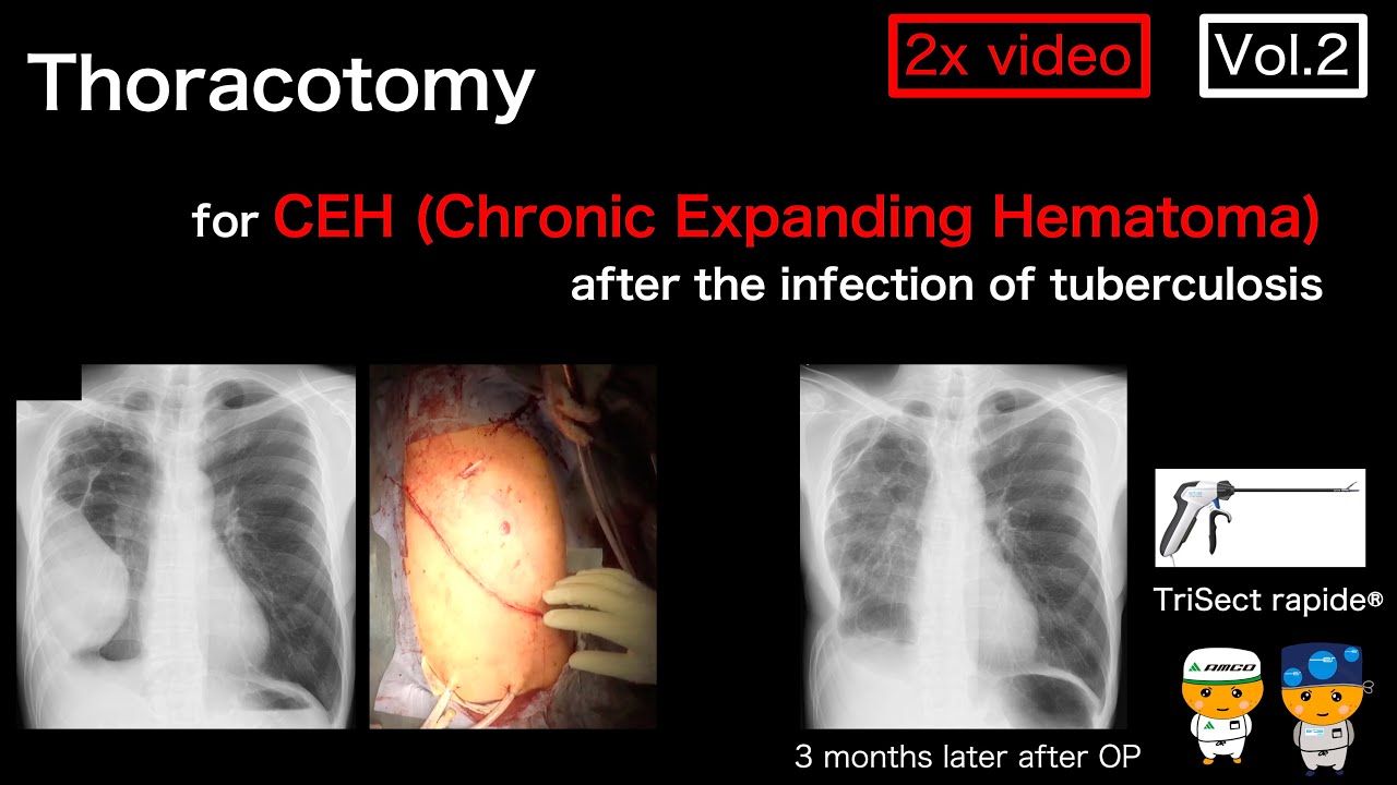Thoracotomy. Hematoma resection for CEH; chronic expanding hematoma ...