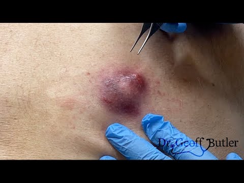 Drainage of an inflamed epidermal cyst on the back - YouTube