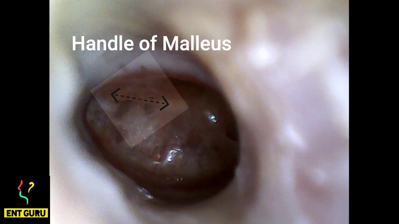 Retracted tympanic membrane - YouTube