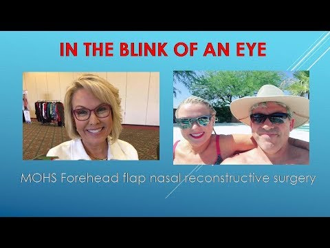 In the Bink of an Eye! A MOHS Forehead Flap Nasal Reconstructive ...
