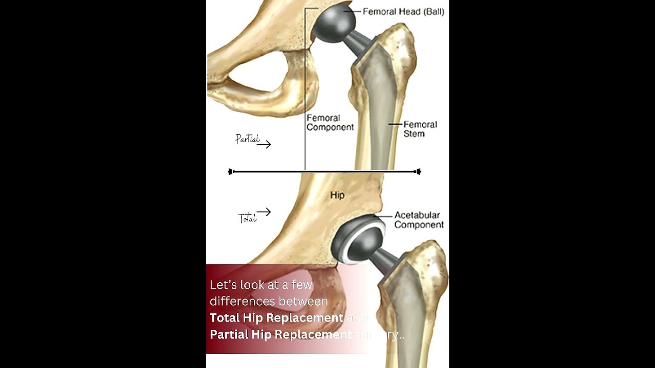 What is | Total Hip Replacement and Partial Hip Replacement | by Dr ...