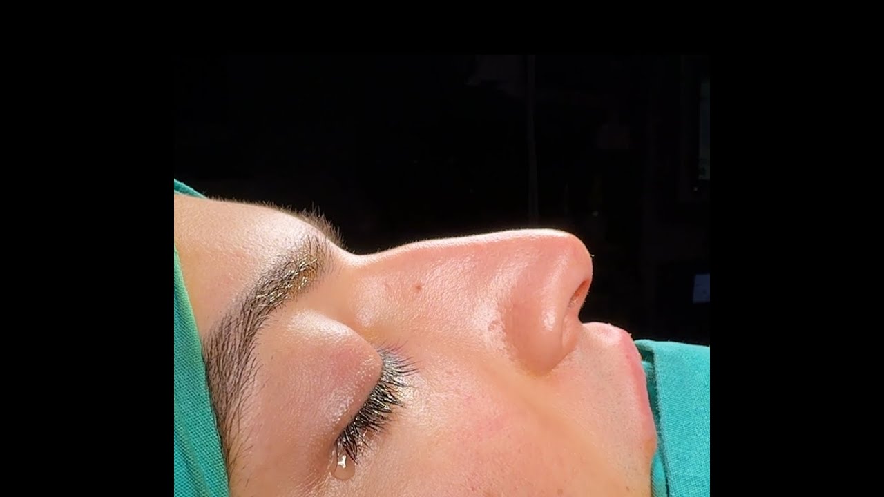 Preservation pushdown rhinoplasty. Real time video (education) - YouTube