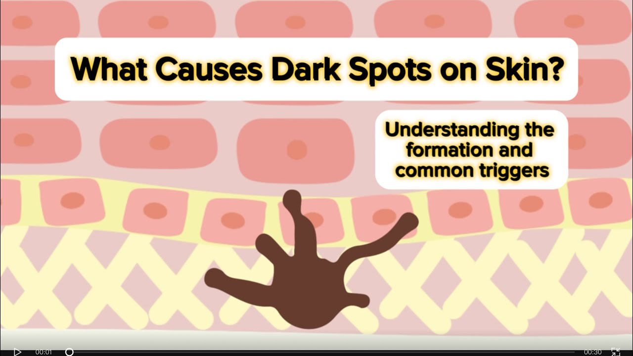 What Causes Dark Spots on Skin? Understanding the Formation and Common ...