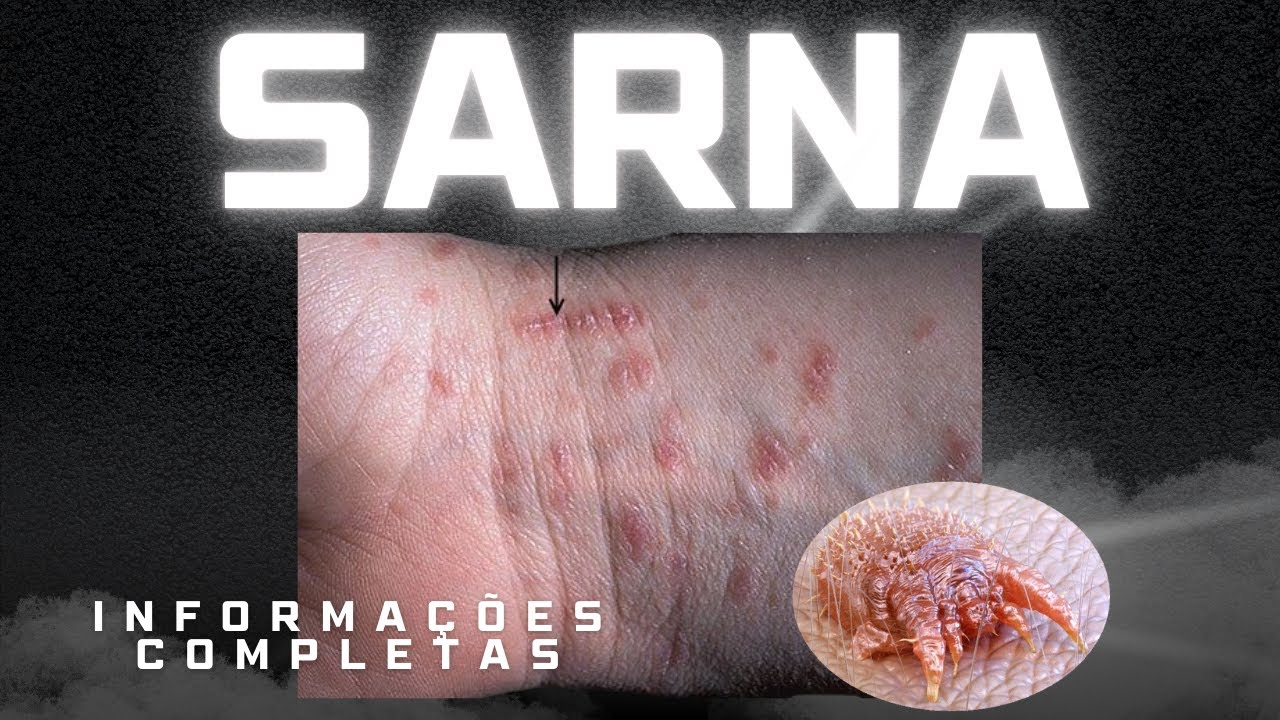 Explicación de la sarna | Síntomas, causas, tratamiento y prevención ...