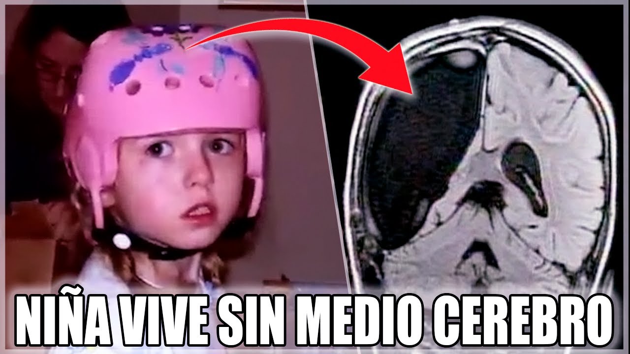 NIÑA VIVE con MITAD de su CEREBRO / CASO CAMERON MOTT - YouTube