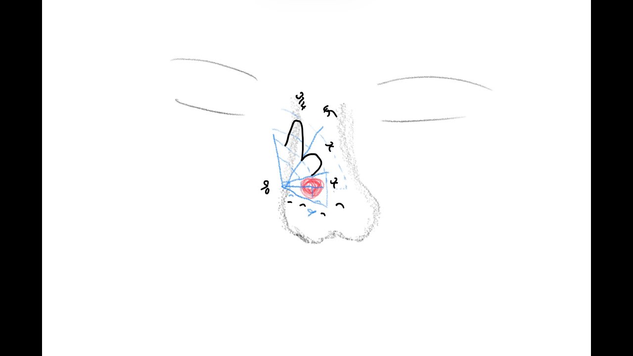 How to draw a Bilobe Flap - YouTube