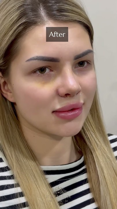 Nose reconstruction after failed surgery! Premium Studio Istanbul - YouTube