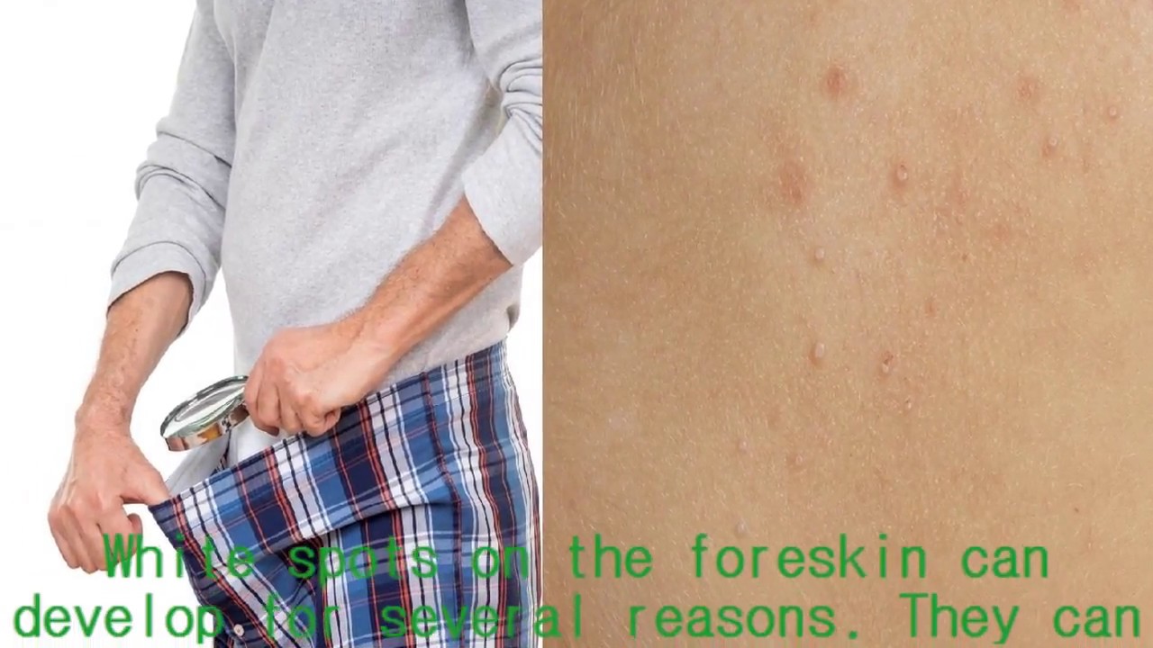 Men s Health News What Are The White Spots On My FORESKIN YouTube men-s-health-news-what-are-the-white-spots-on-my-foreskin-youtube