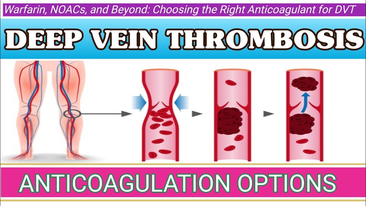 Anticoagulation Therapy For Deep Vein Thrombosis - YouTube