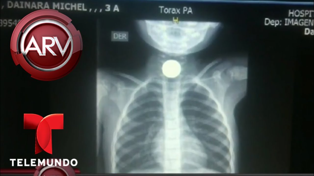 Niña se traga moneda y se le queda atorada en el esófago | Al Rojo Vivo ...