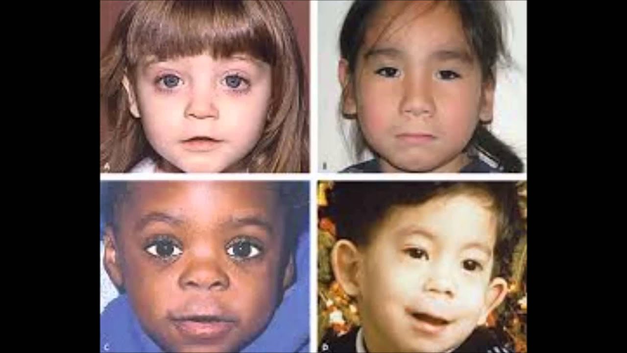 Fetal Alcohol Syndrome (FAS) Commercial - YouTube