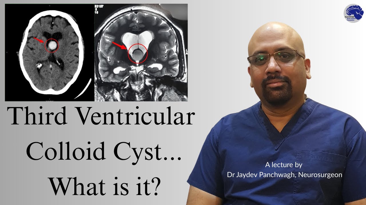 Benign Brain Tumor-Colloid Cyst in Brain I Dr Jaydev Panchwagh - YouTube