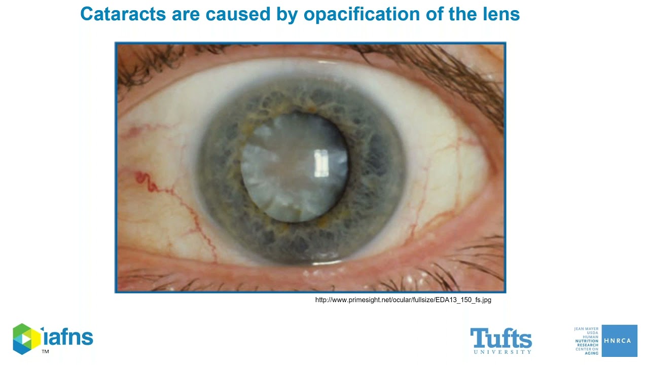 IAFNS – HNRCA- Tufts webinar- Delaying eyes disease with Nutrition ...