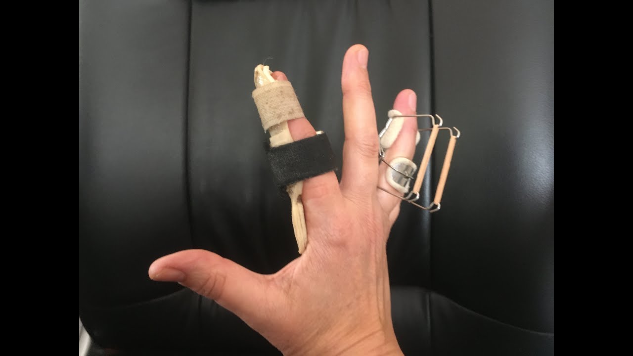 finger rehab post dislocation or fracture - YouTube