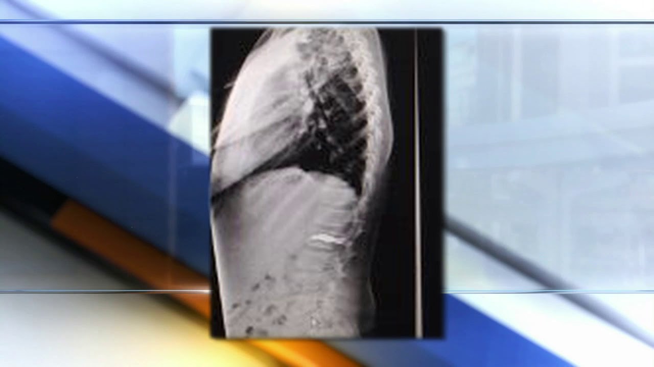 Florida boy with rare condition gets help at Hopkins; Doctors inserted ...