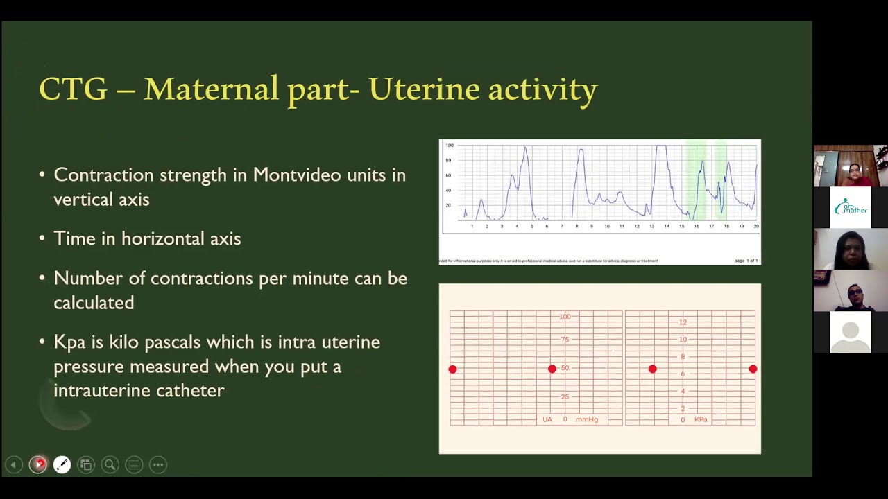 CTG Interpretation in labour room - YouTube
