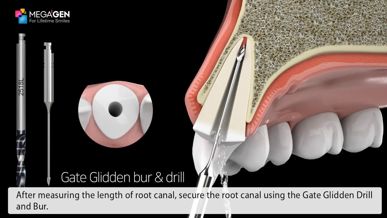 Root Membrane Kit - YouTube
