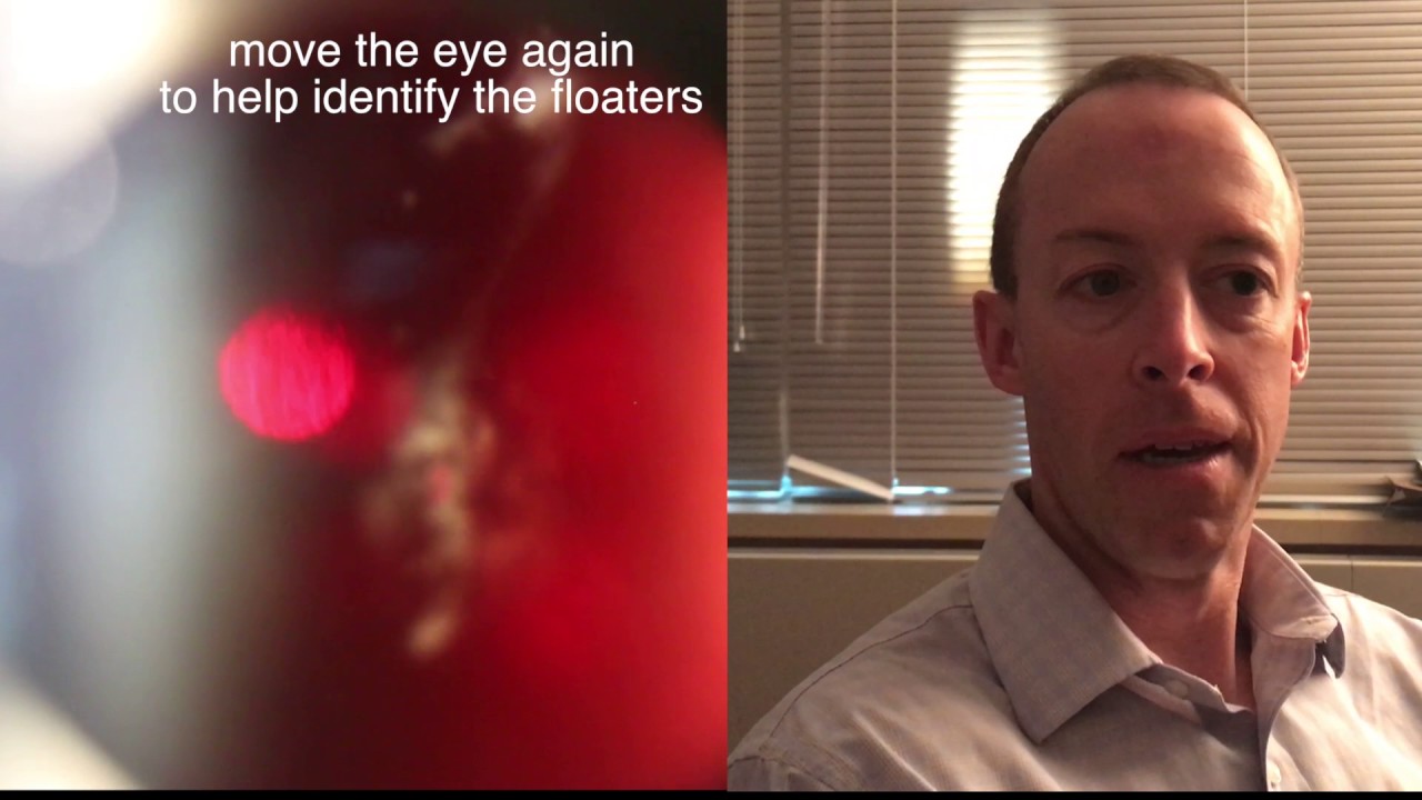 Laser Floater Removal (vitreolysis) patient procedure and testimonial ...