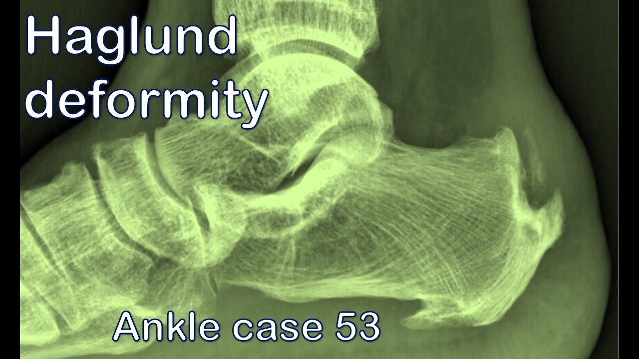 Haglund deformity - ankle 53 ENG - YouTube