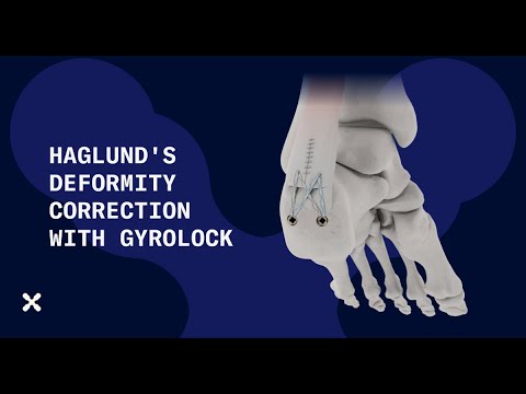 Haglund’s Deformity Correction | Surgical Technique with Auxein’s ...