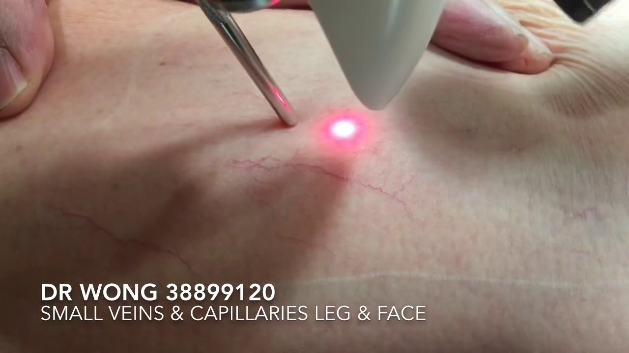 Laser treatment to reduce capillaries and veins in legs and face - YouTube