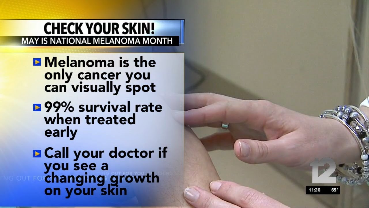 OHA says to check your skin for melanoma - YouTube