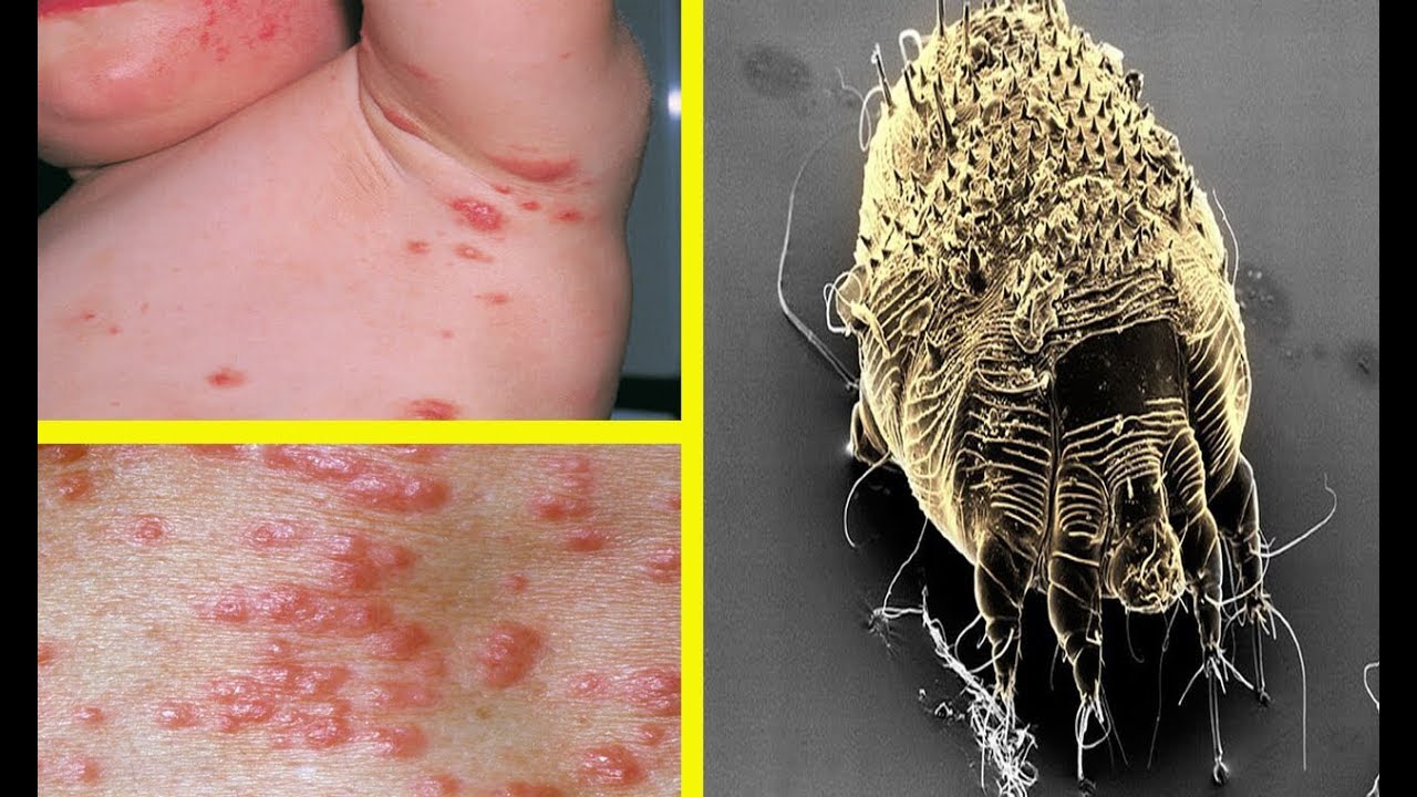 Scabies What Is It ? Signs, Symptoms, Causes, Spread and Treatment ...