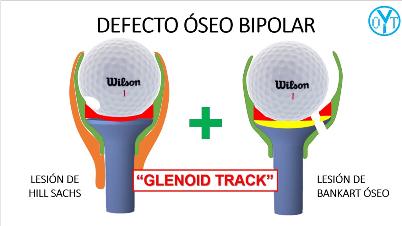 glenoid track de hombro o defecto óseo bipolar - YouTube